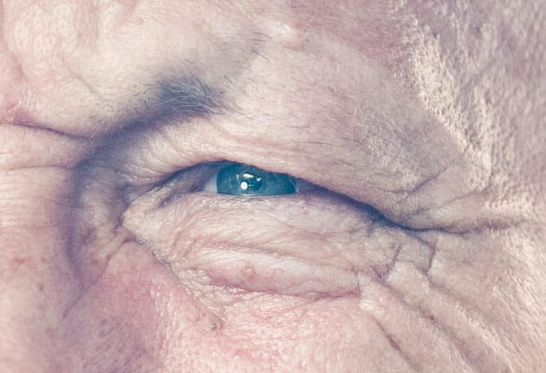 Maculapucker - Eyescan