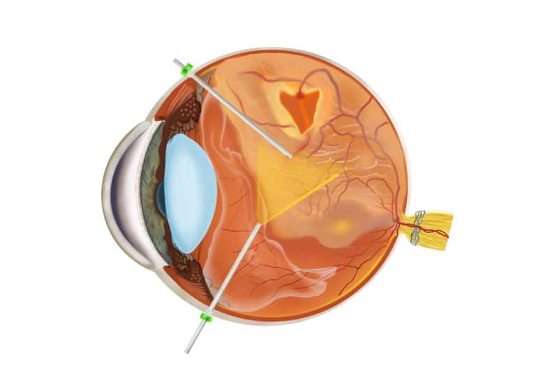Best | Retina Operatiecentrum - Eyescan